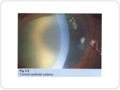 Cornea PPT Eye And Vision Conditions Diseases And Conditions
