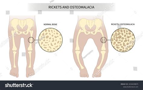 Rickets Blounts Pagets Disease Hip Low Stock Vector Royalty Free