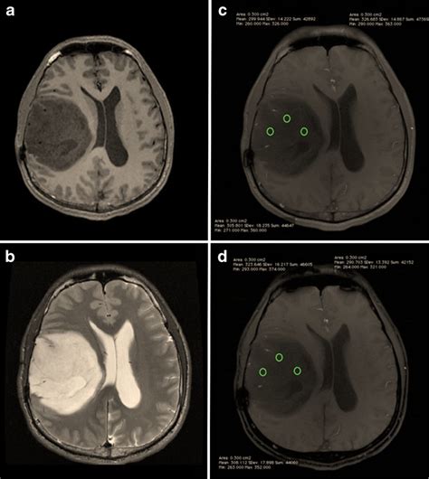 Novel Application Of Chemical Shift Gradient Echo In And Opposed Phase