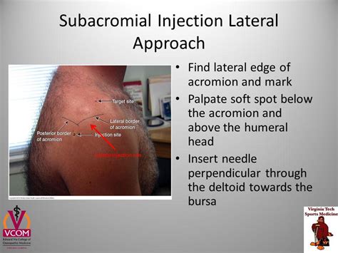 Shoulder Girdle Joint Injection Workshop Ppt Video Online Download