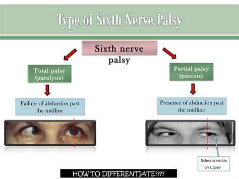 Sixth Cranial Nerve Palsy Understanding Sixth Nerve Palsy Ajya