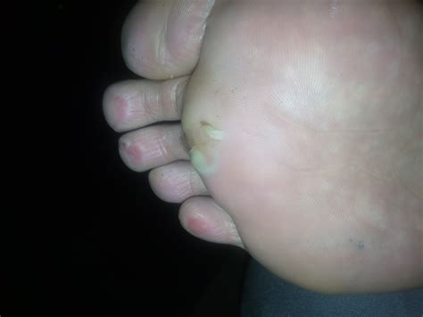 ظهور بقع بيضاء تحت جلد القدم استشارات طبيب دوت كوم