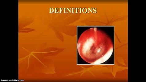 Otitis Media Effusion
