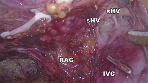 Laparoscopic Anatomical Liver Segment Vii Resection With Liver Parenchymal Transection Following