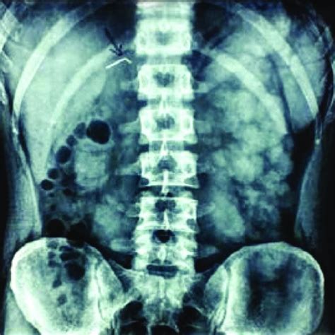 X Ray Abdomen Showing Foreign Body In Stomach Download Scientific
