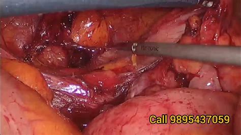 Acute Appendicitis Laparoscopic Appendicectomy Is The Best Treatment Youtube