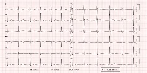Syndrome Du Qt Long Éducoeur Par Liryc