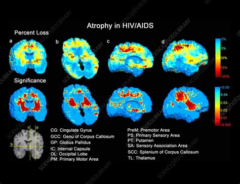 brain disease caused by aids at sherry starks blog
