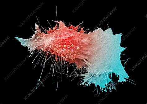 Cervical Cancer Cell Sem Stock Image C059 0049 Science Photo Library