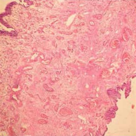 Fibroepithelial Polyp Histology