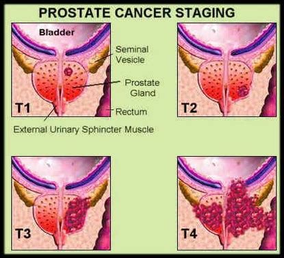 Diagram Prostate Cancer Stages Anatomy System Human Body Anatomy Diagram And Chart Images