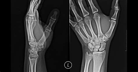 Scapholunate Ligament Tear Any Others Imgur