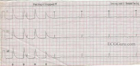 Pacemaker Ecg Guru Instructor Resources
