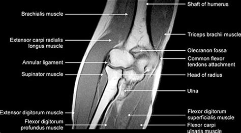 Elbow Anatomy Muscles Mri