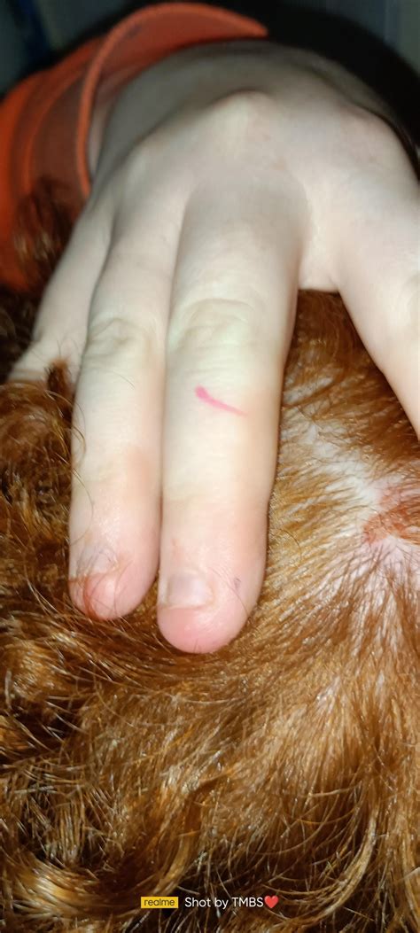 Marked Nsfw Due To Raw Looking Lesion On Scalp Is This Part Of Cfs Me I Dont Know Whats