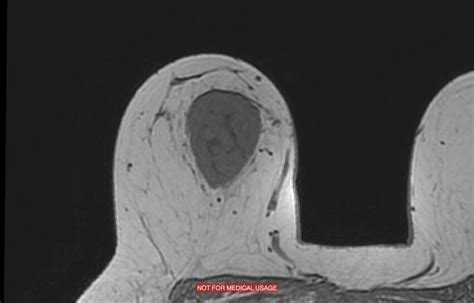 Radiopaedia Case Pseudoangiomatous Stromal Hyperplasia Mri Id 39249