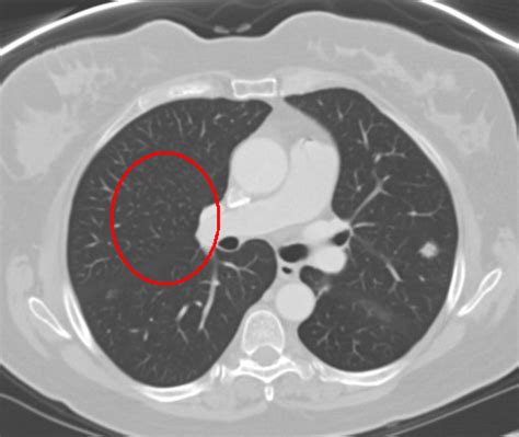 Lungs Opacities In Lungs