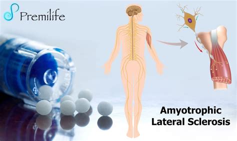 Amyotrophic Lateral Sclerosis Premilife Homeopathic Remedies