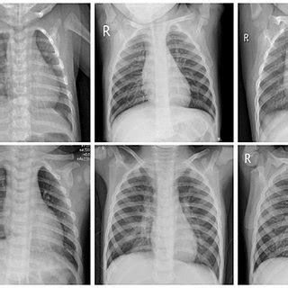 Samples Of Each Class Of The CXR Dataset From Left To Right Sets Of Download Scientific
