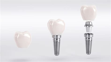 구강학 세트를 위한 치아와 치과 임플란트의 3d 렌더링 임플란트 수술 개념 임플란트에 대한 스톡 사진 및 기타 이미지 임플란트 치아 건강 디지털 생성 이미지 Istock