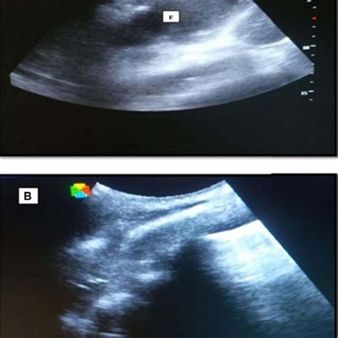 Thoracic Ultrasound A Complex Pleural Effusion With Loculation B