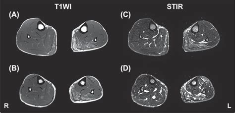 Muscle Mri On Admission Download Scientific Diagram