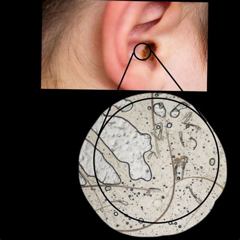 aryan anshu devil on linkedin bacterial from ear