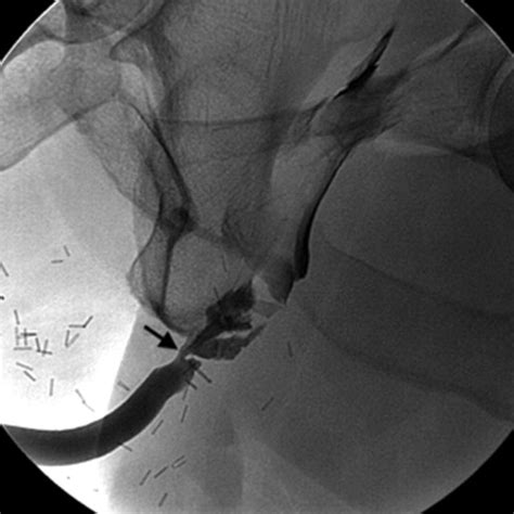 Fluoroscopic Retrograde Urethrogram Evaluation Of The Neophallus Of A Download Scientific