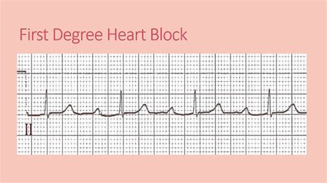 Ecg Criteria For Complete Heart Block At Ken Escobar Blog