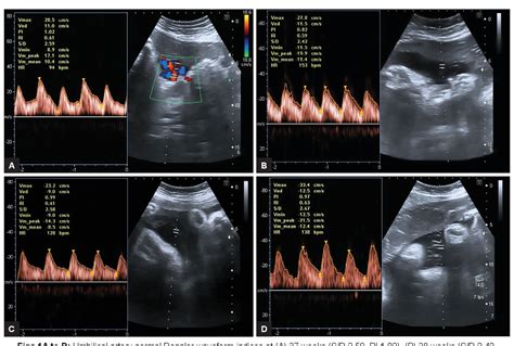 Figure 1 From Umbilical Artery Doppler Waveform Indices At Term