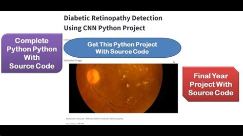 Prof Roshan Helonde On Linkedin Diabetic Retinopathy Detection Using