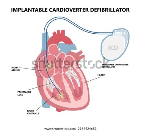 Implanted Defibrillator Over 144 Royalty Free Licensable Stock