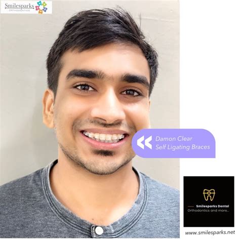 Dr Bala Vignesh Sah On Linkedin Dental Dentalcare Dentalclinic