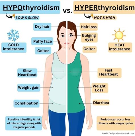 Dina Hussein Eladly On Linkedin Hypothyroidism Vs Hyperthyroidism