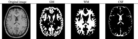 Segmentation Of A Brain Mri Into Gm Wm And Csf Tissues By Spm Download Scientific Diagram