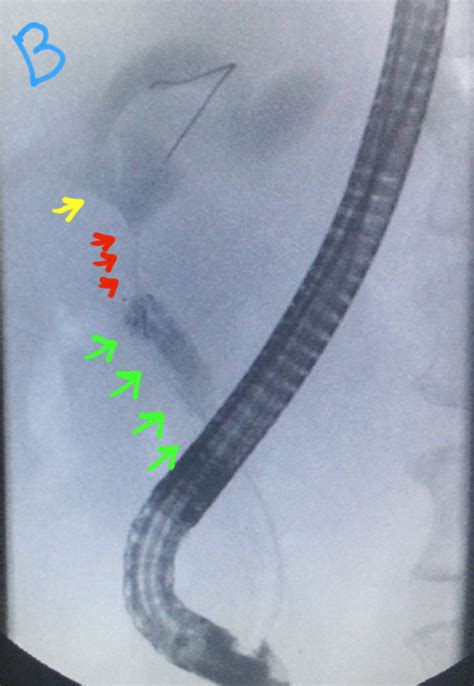 Ercp And Egd Unintended Deployment Of Metallic Stent And Re Stenting
