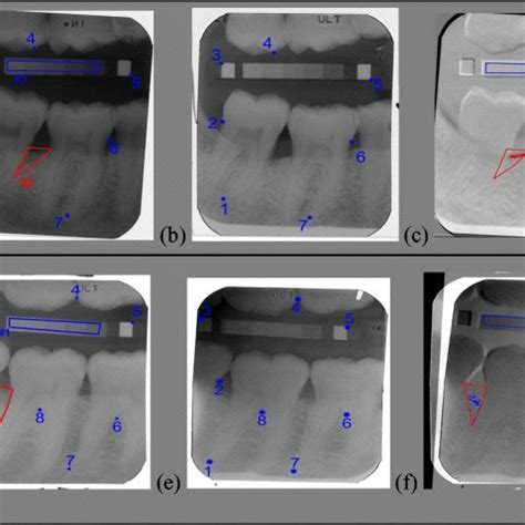Subtraction Radiography A D Baseline Radiographs Fixed Points Were Download Scientific