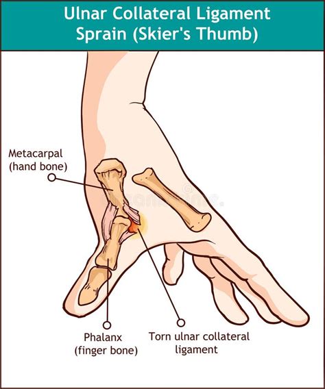 Ulnar Collateral Ligament Sprain Skier`s Thumb Stock Vector
