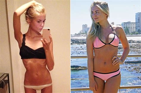 This Recovering Anorexic Hopes People Notice Just How Much Weight Shes