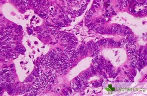 ᐉ Рак на стомаха — Lecheniebg