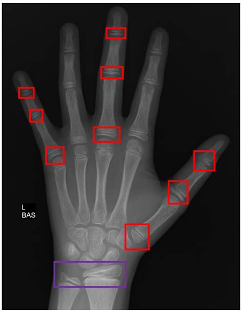 How To Calculate Bone Age Radiology At Keith Herrera Blog