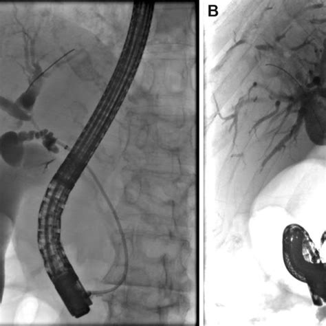 Spyglass Cholangioscopy Demonstrating Infiltrative Mass In The Bile Spyglass Cholangioscopy Demonstrating Infiltrative Mass In The Bile