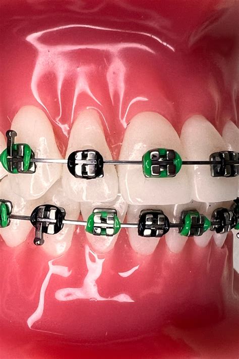 Green And Black Braces More Inspiring Green Braces Combinations Green Braces Braces Colors