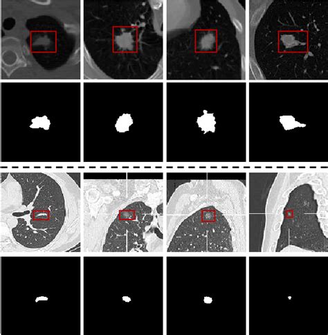 Figure 1 From Lung Nodule Segmentation Algorithm With Smr Unet