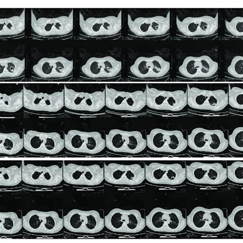 A Before Treatment Of Bronchoscopic Instillation Chest Ct Shows A