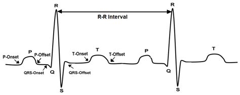 Normal Qrs Time