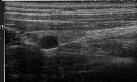 Primary Hyperparathyroidism Clinician S Brief