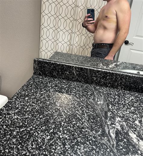 5 Days Post Op Rgynecomastia