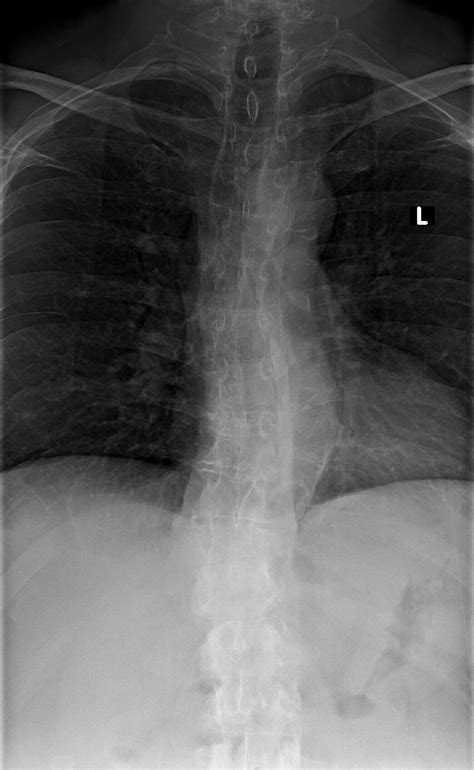 OrthoDx Thoracic Compression Fracture Clinical Advisor