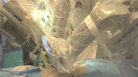 Robotic Assisted Cholecystectomy Single Port Hd Youtube